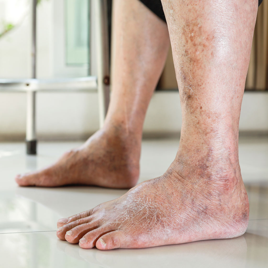 Signs and Symptoms of Peripheral Vascular Disease: What You Need to ...